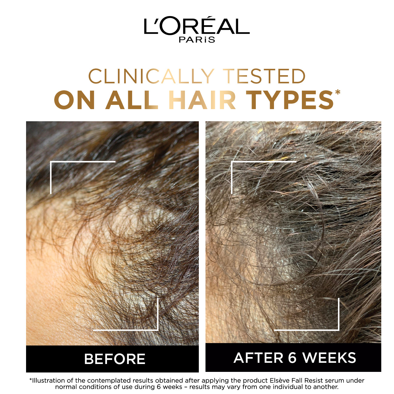 L'Oréal Paris Elvive Aminexil Serum | Hair Serum – Feel22