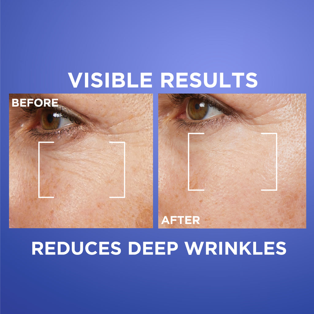 L'Oréal Paris Revitalift Retinol Night Serum For Face With 0.2% Pure ...